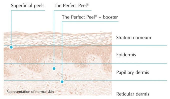 The Perfect Peel | Skincare Treatments in North London