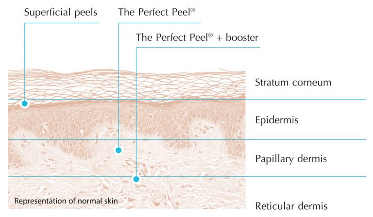 The Perfect Peel | Skincare Treatments in North London