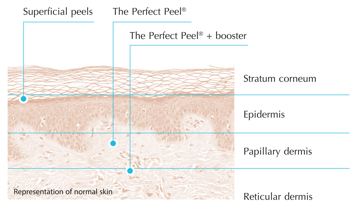 The Perfect Peel | Skincare Treatments in North London