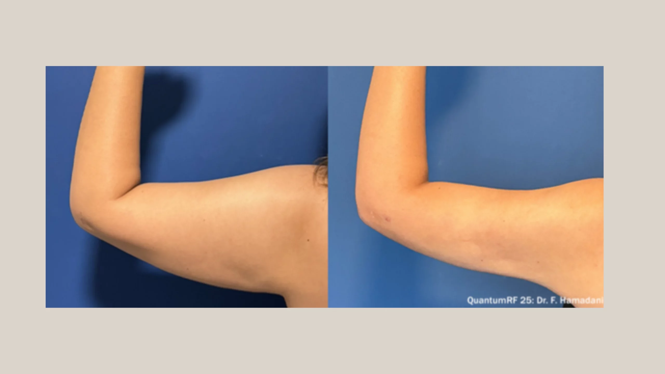 Non Surgical Arm Lift London Expert Firming and Contouring